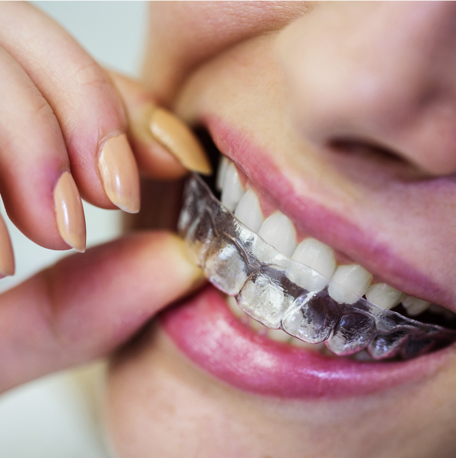 Invisalign Treatment | Tooth Embrace Shivaay Dental Clinic